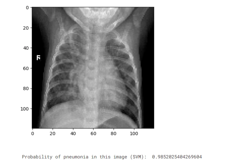 ML Beginner's Guide To Build Pneumonia Detection Model